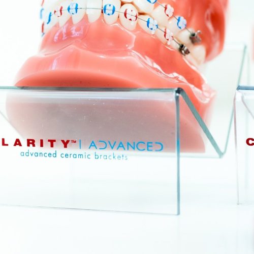 3M Clarity Clear Braces - Larson Orthodontics in Alexandria, VA