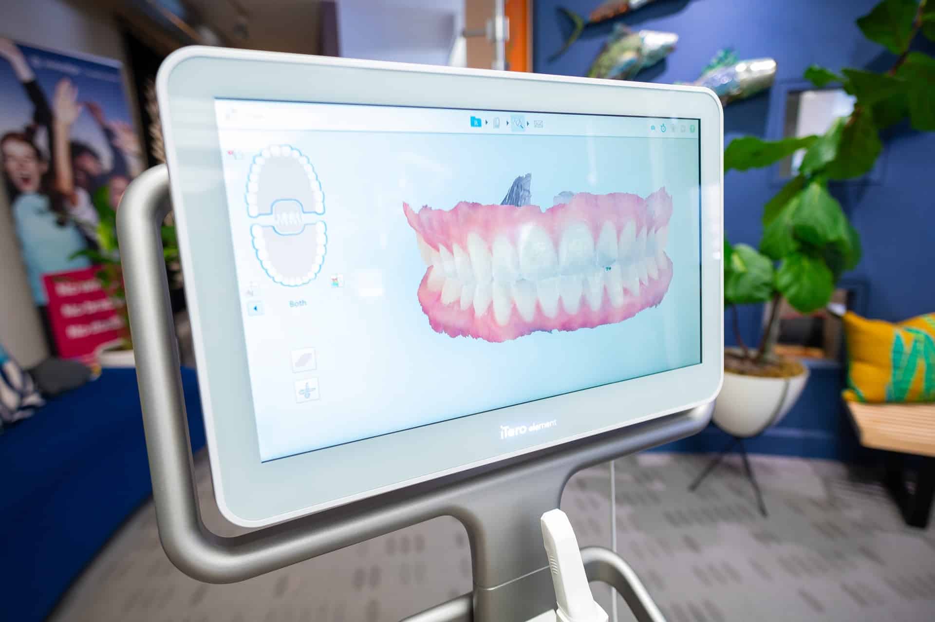 Spark Clear Aligners | Alexandria, VA | Larson Orthodontics