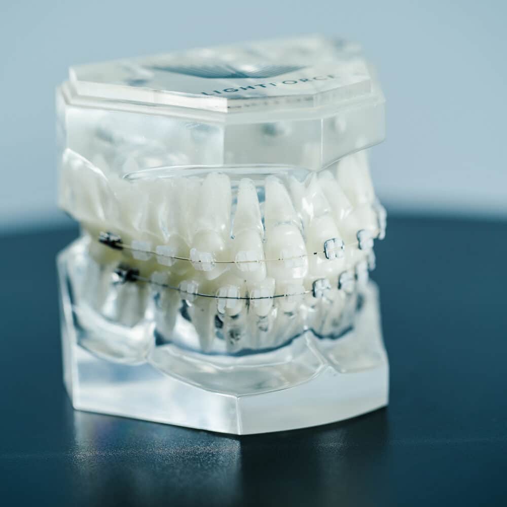 LightForce Braces | Alexandria, VA | Larson Orthodontics